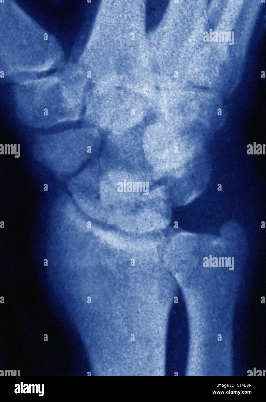 FRACTURED HAND, X-RAY Stock Photo - Alamy