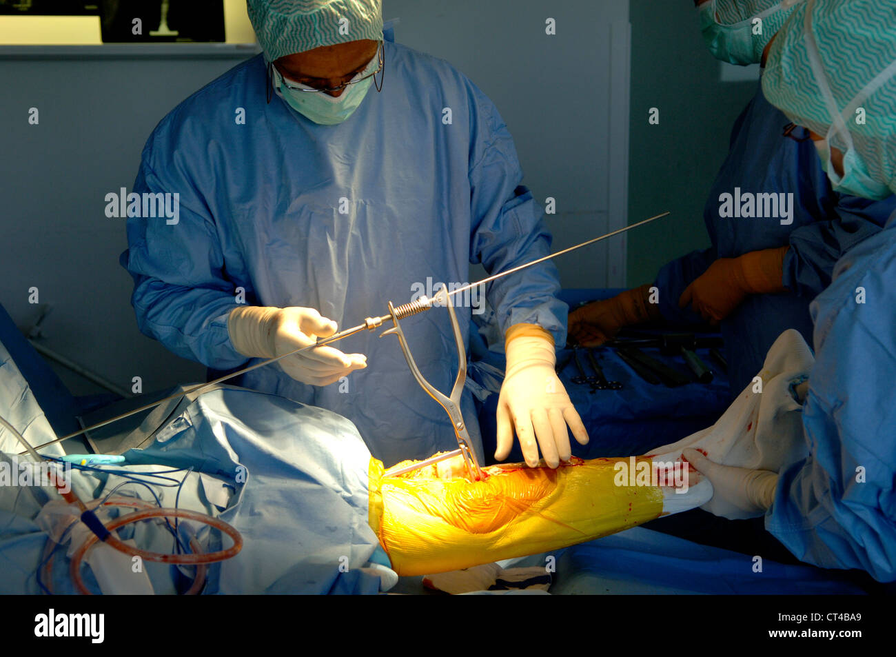 KNEE PROSTHESIS, SURGERY Stock Photo - Alamy