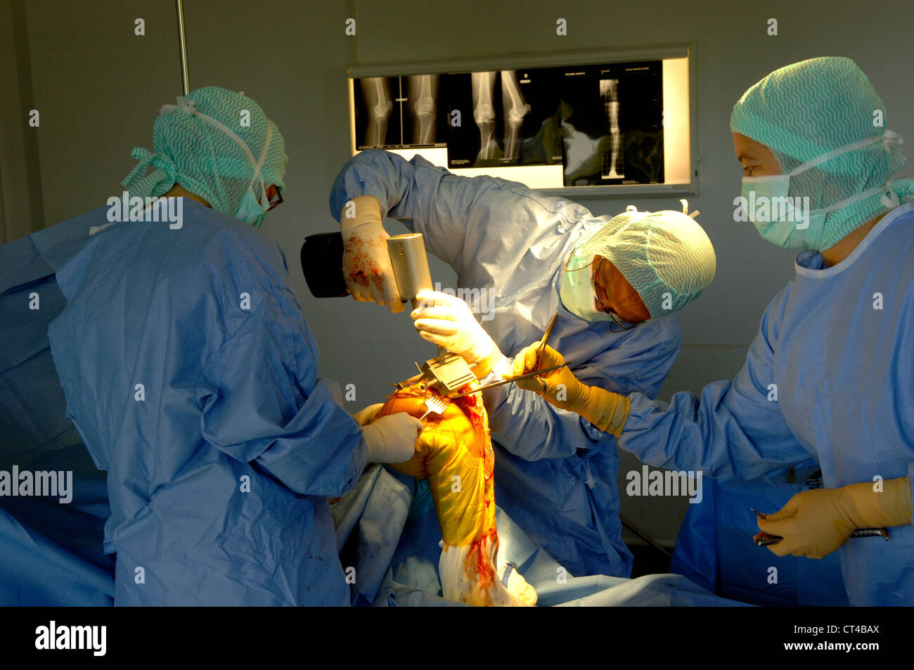 KNEE PROSTHESIS, SURGERY Stock Photo - Alamy