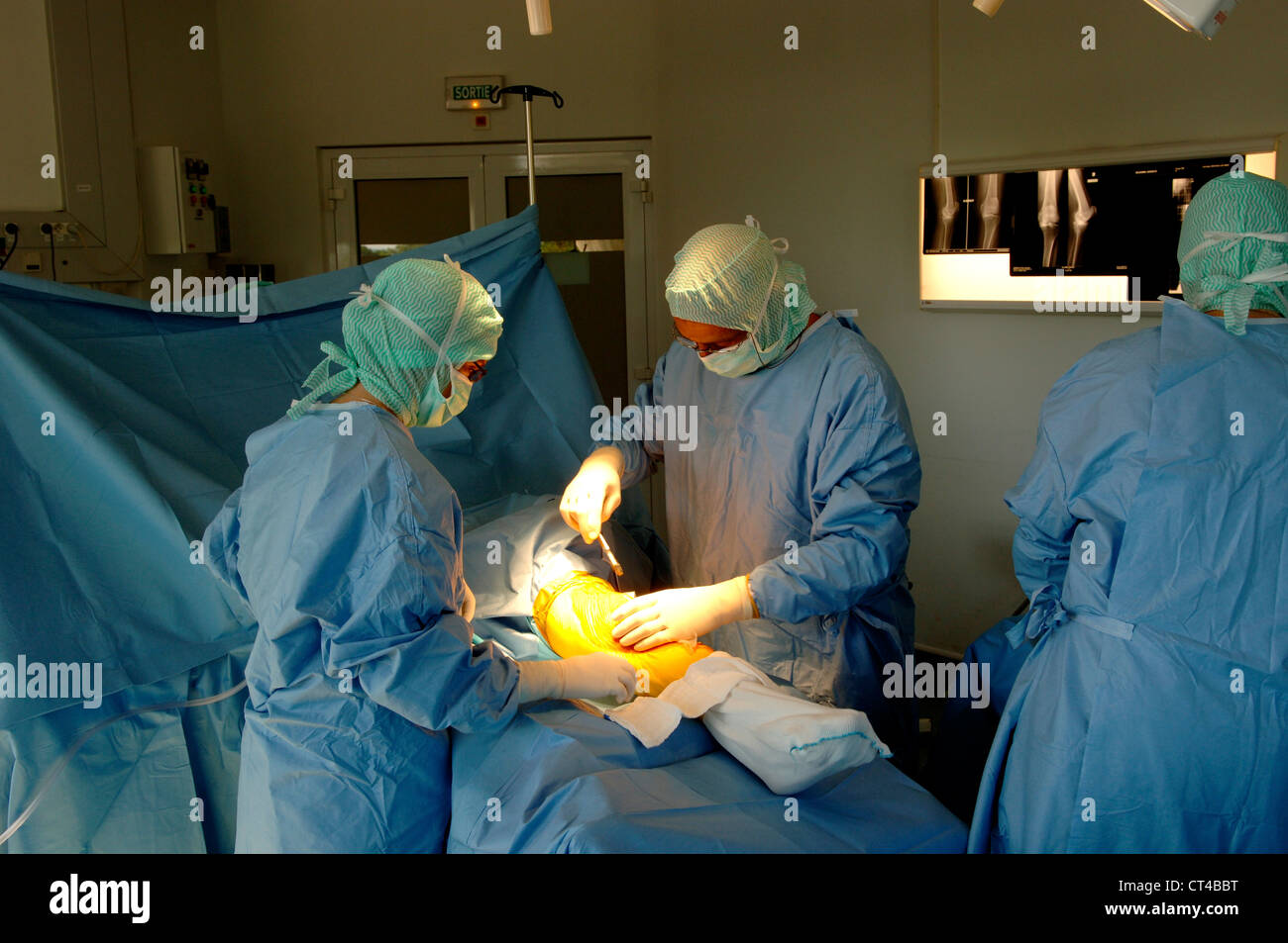 KNEE PROSTHESIS, SURGERY Stock Photo - Alamy