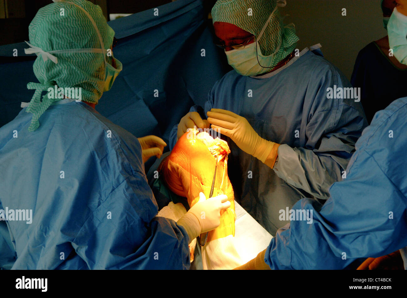 KNEE PROSTHESIS, SURGERY Stock Photo - Alamy