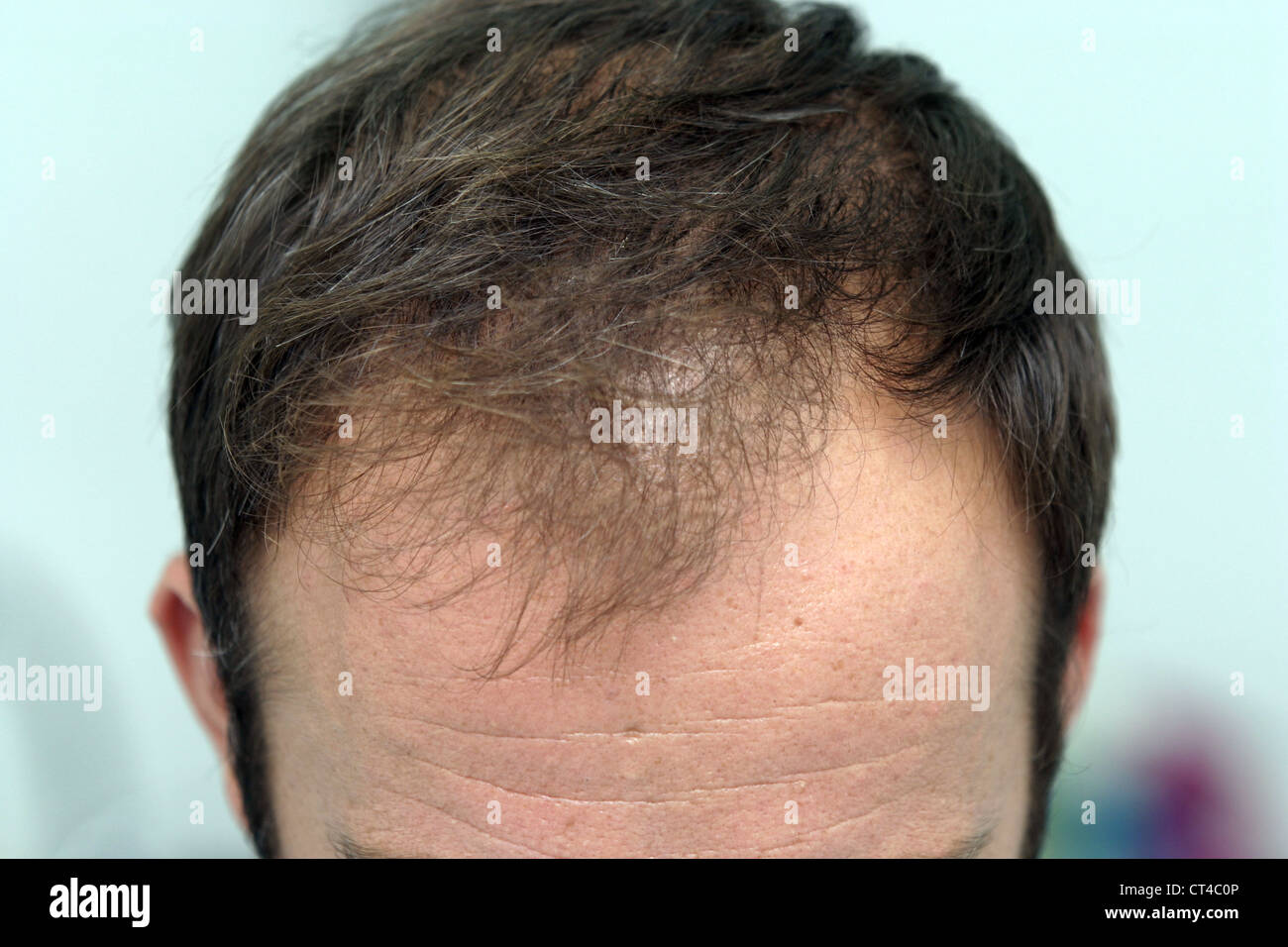 IMPLANT HAIR SURGERY Stock Photo - Alamy