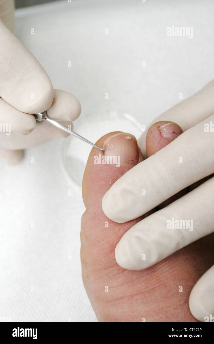 Human fungal infections hi-res stock photography and images - Alamy