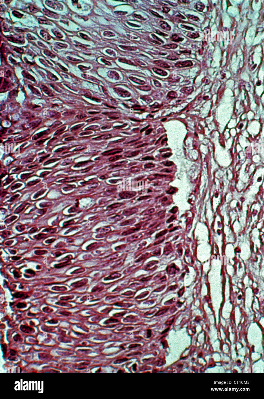 CANCER OF THE UTERUS, HISTOLOGY Stock Photo - Alamy