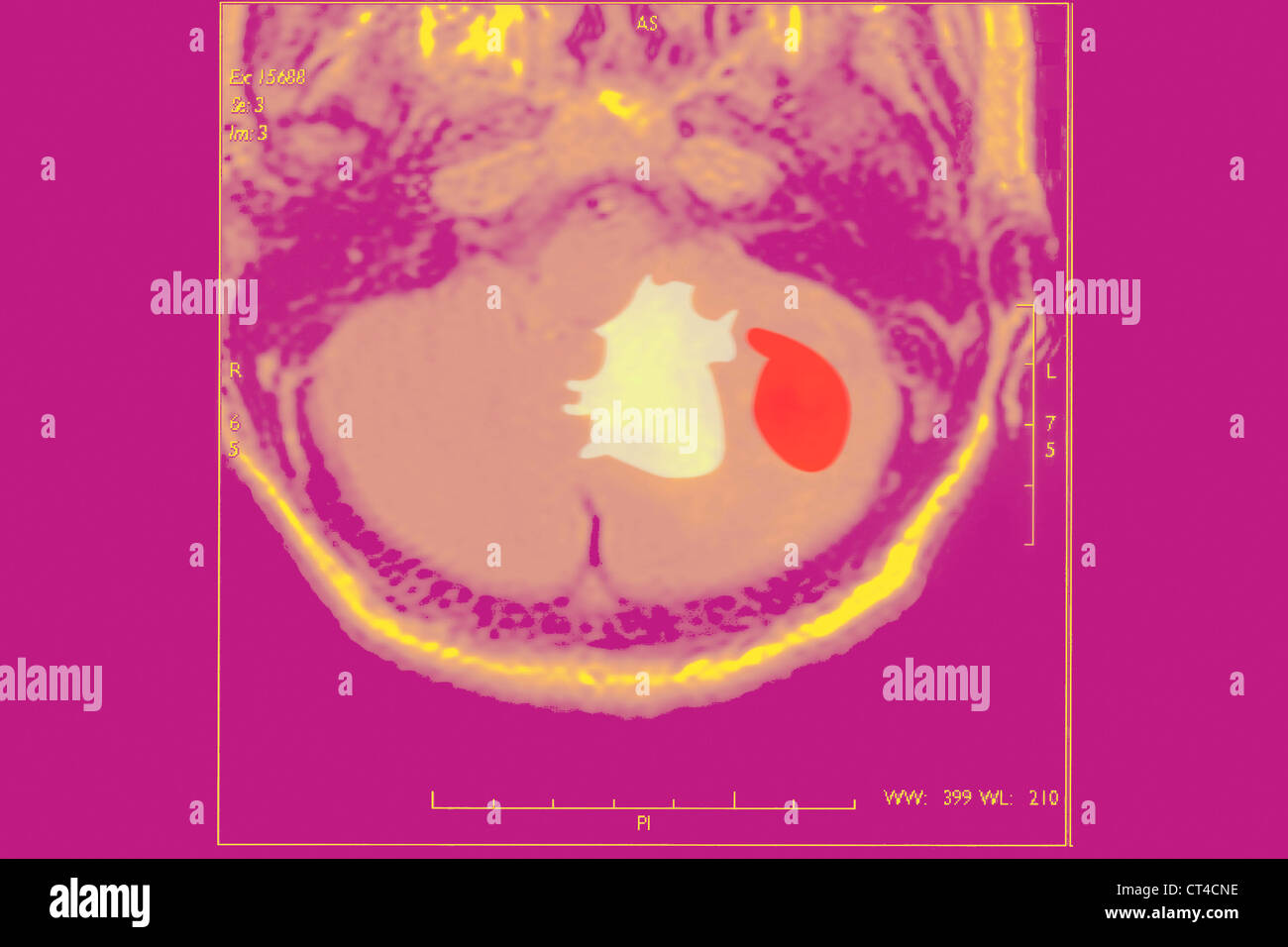 METASTASIS IN THE BRAIN, MRI Stock Photo - Alamy