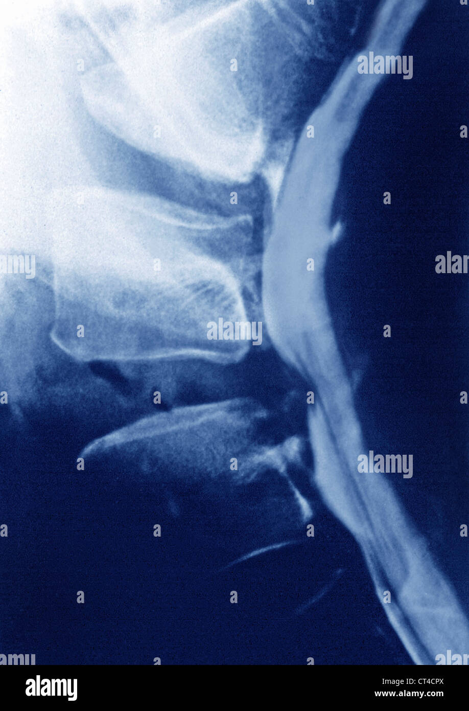 Herniated cervical discs hi-res stock photography and images - Alamy