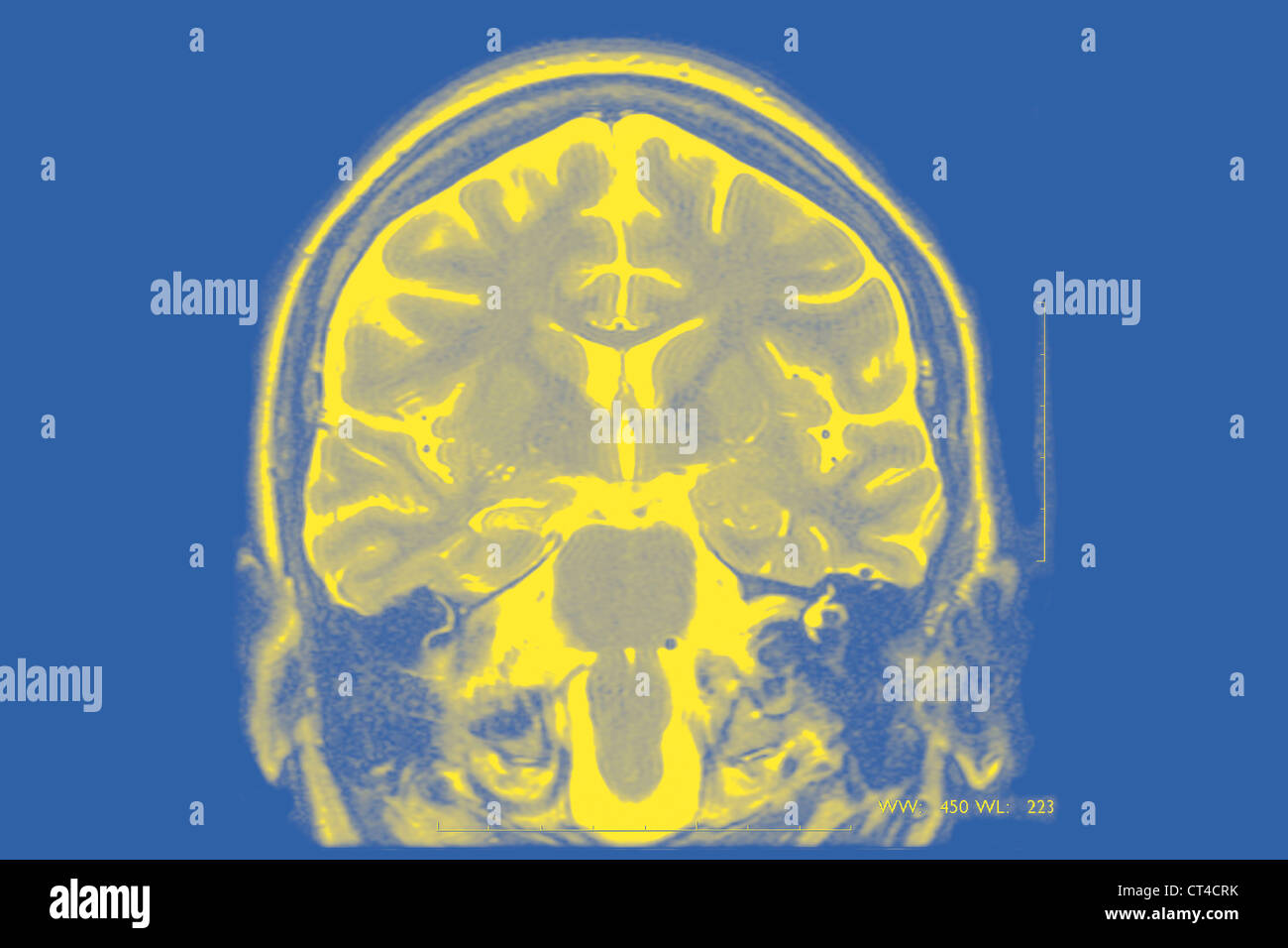 Hippocampus Brain Mri