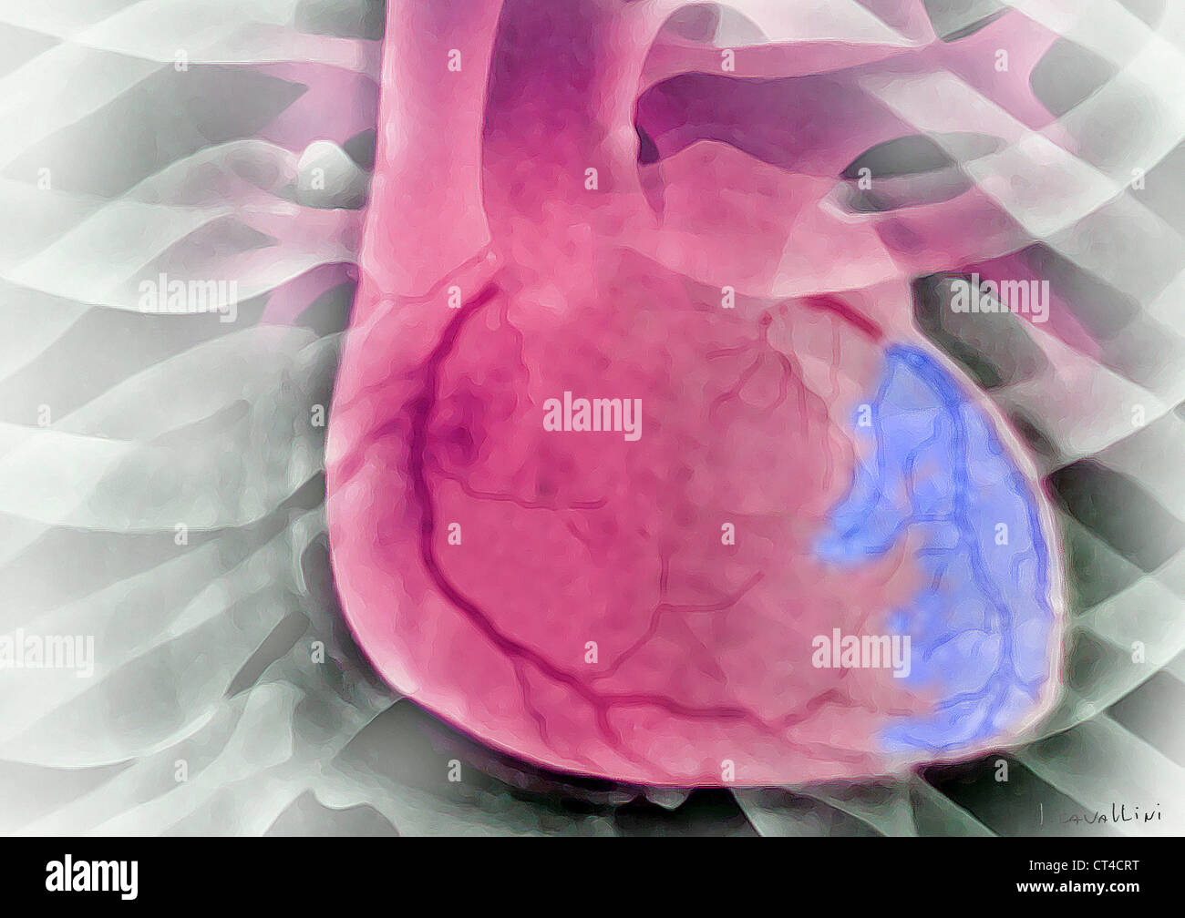 HEART ATTACK, DRAWING Stock Photo - Alamy