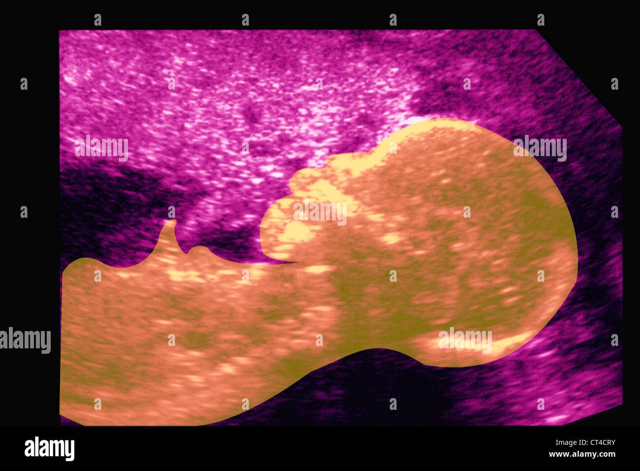 22 week old fetus hi-res stock photography and images - Alamy