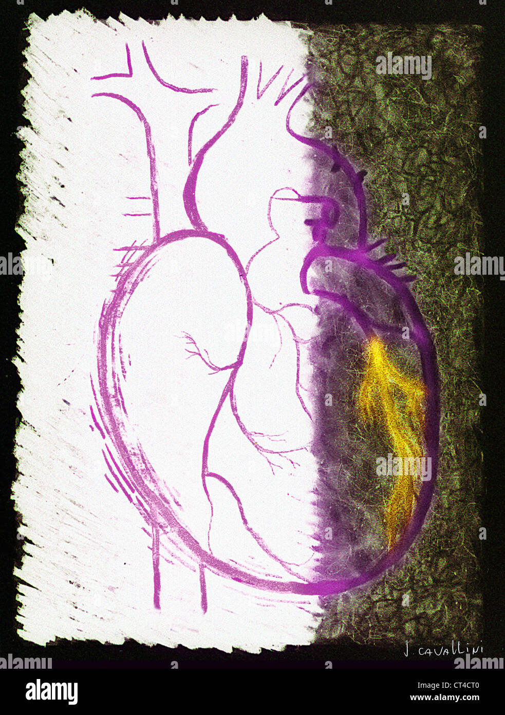 HEART ATTACK, DRAWING Stock Photo - Alamy