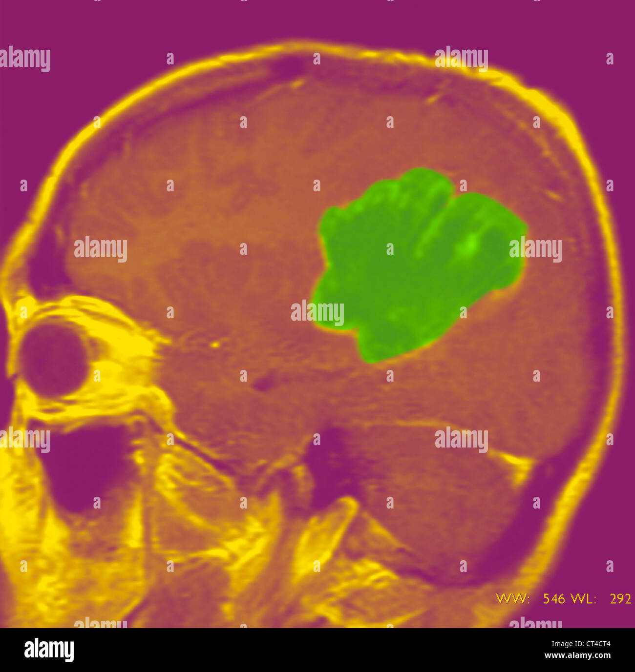 Glioblastoma hi-res stock photography and images - Alamy
