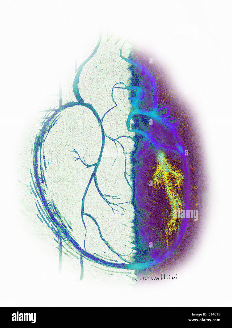 HEART ATTACK, DRAWING Stock Photo - Alamy
