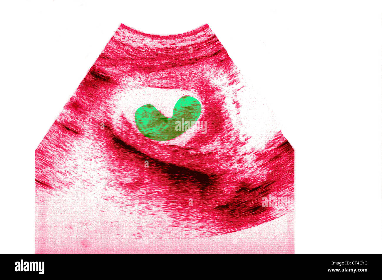 ULTRASOUND BIOMETRY OF THE FETUS Stock Photo - Alamy