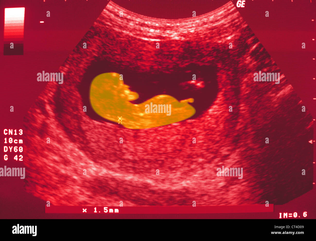 3 months fetus hi-res stock photography and images - Alamy