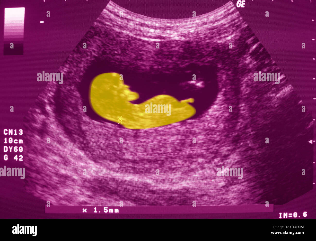 Baby Ultrasound At 12 Weeks