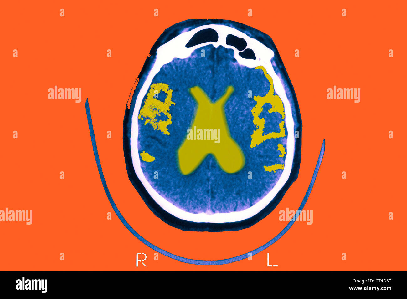 Alzheimers brain scan hi-res stock photography and images - Alamy
