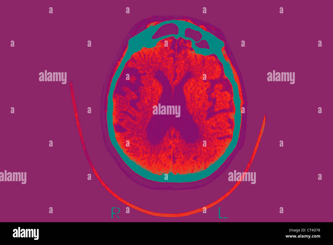 Alzheimer Brain Scan High Resolution Stock Photography and Images - Alamy