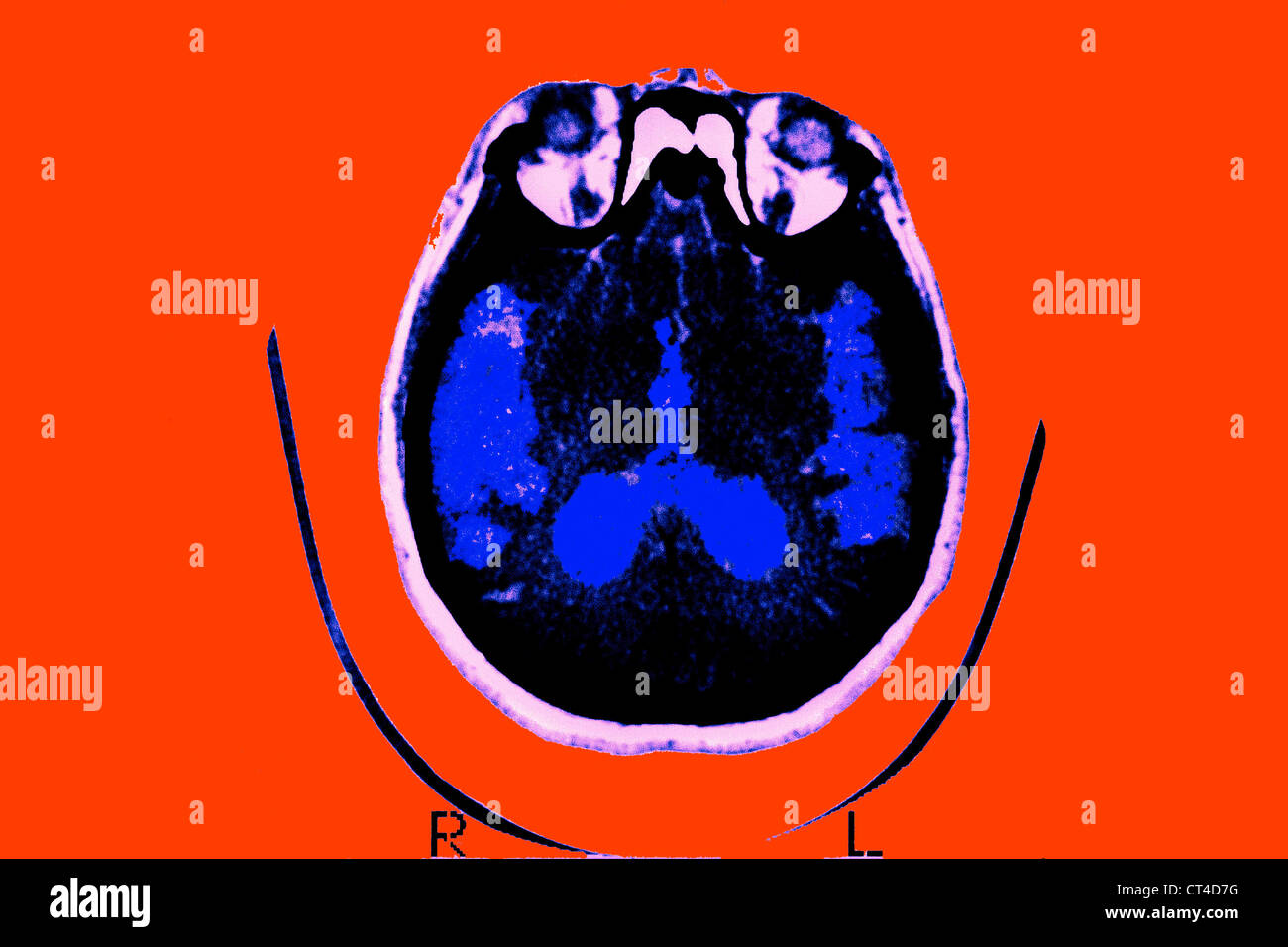 Brain Scan Alzheimer's High Resolution Stock Photography and Images - Alamy