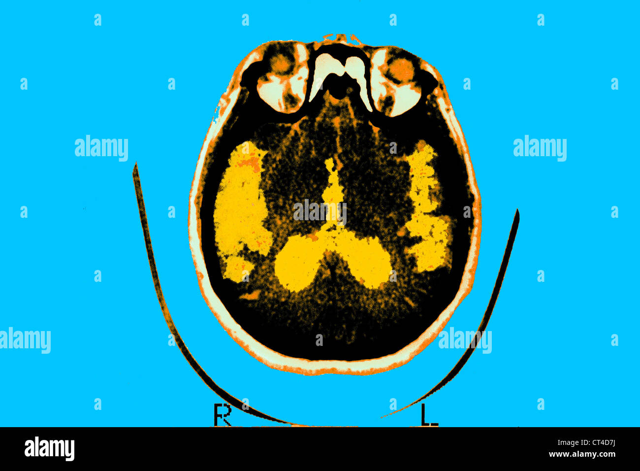 Alzheimers brain scan hi-res stock photography and images - Alamy