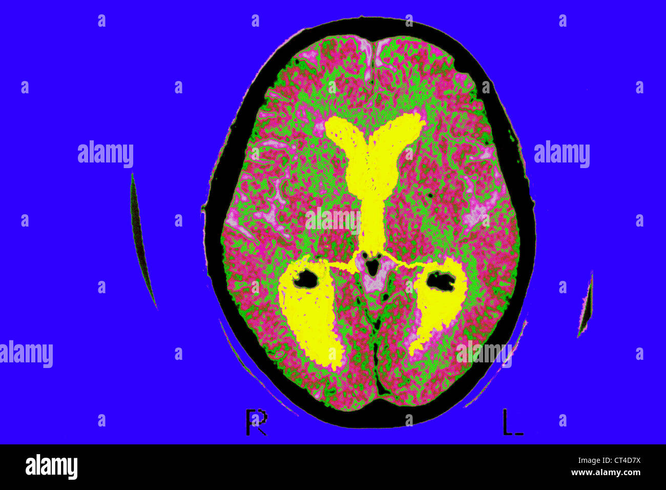 Dementia brain scan hi-res stock photography and images - Alamy