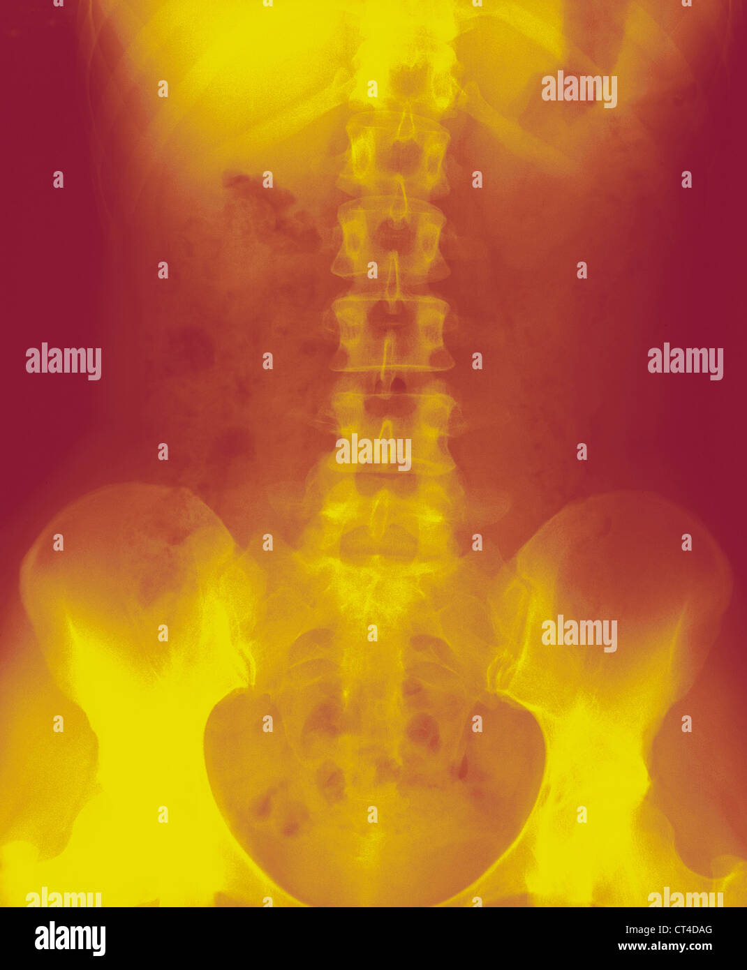 X ray normal lumbar spine hi-res stock photography and images - Alamy
