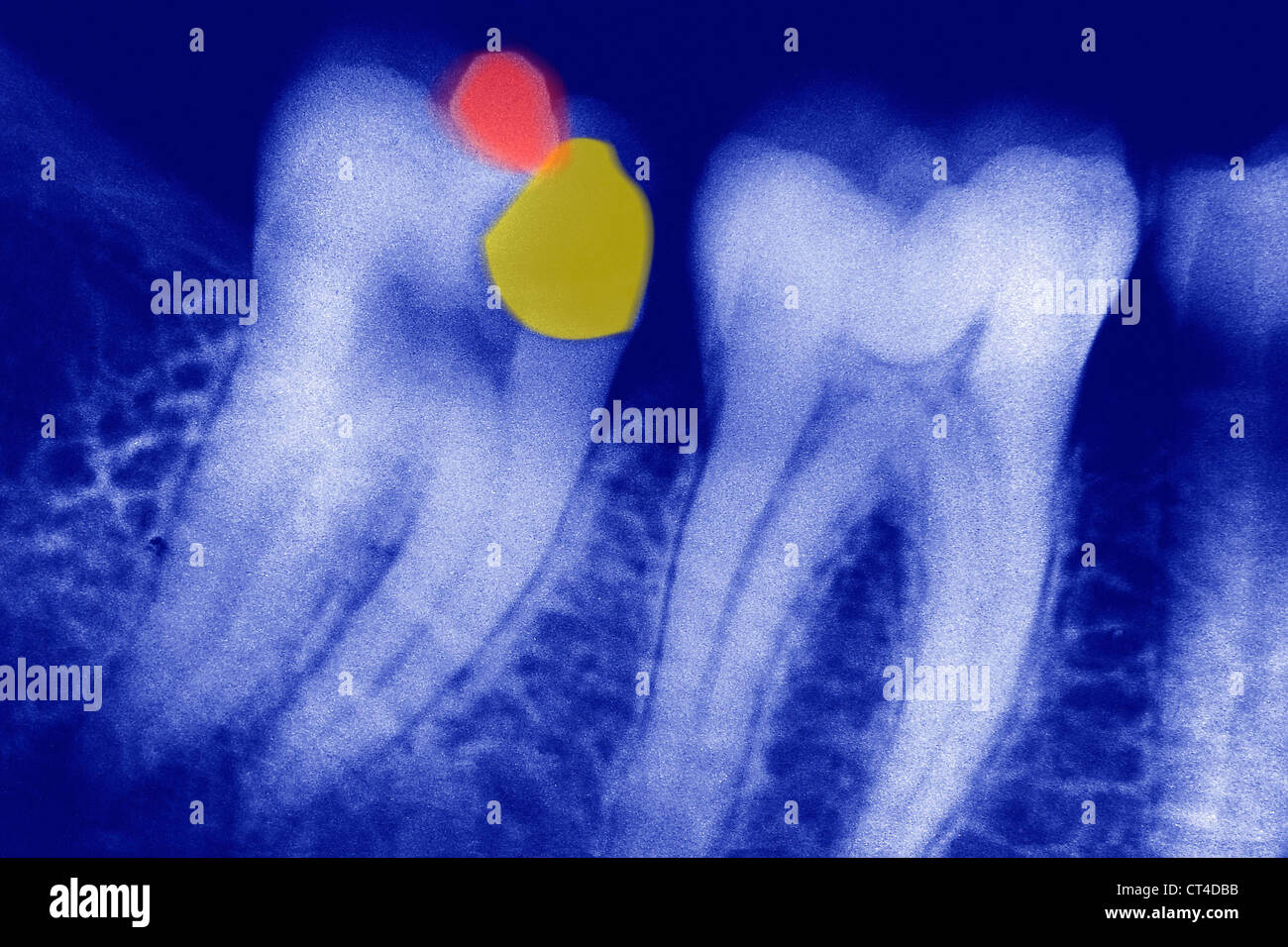 Amalgam filling hi-res stock photography and images - Alamy