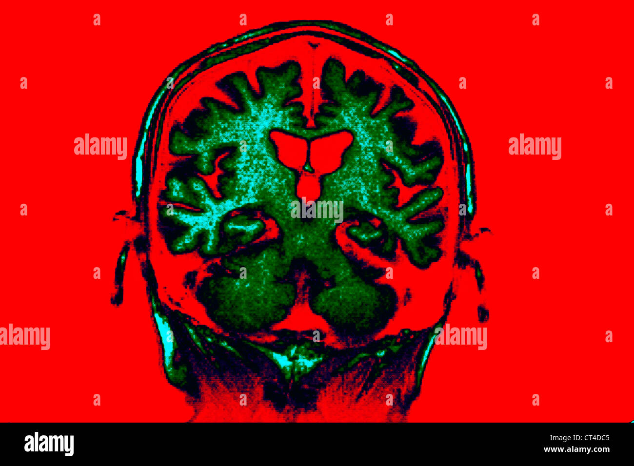 Human brain memory mri hi-res stock photography and images - Alamy