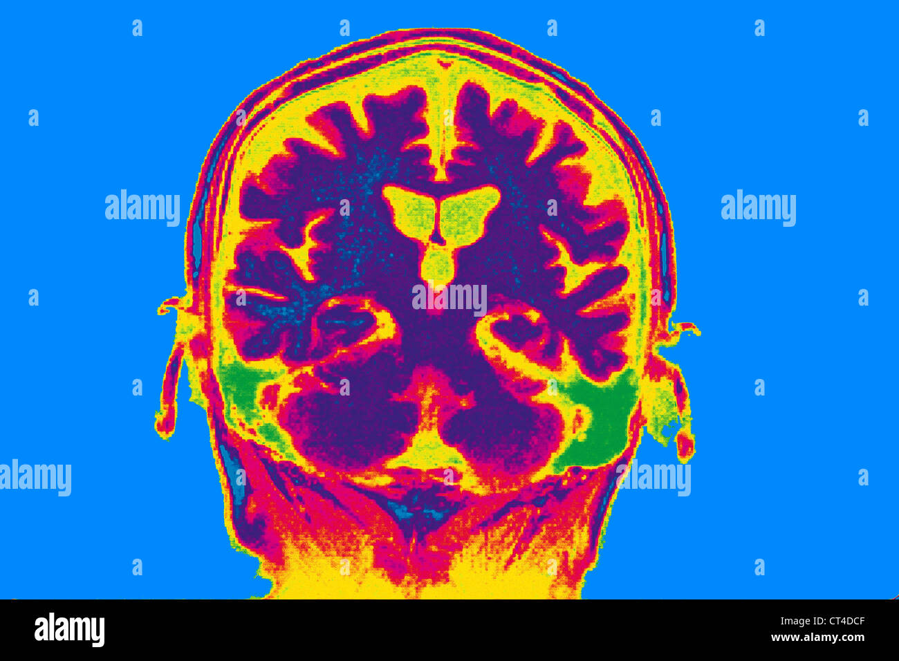 Human Brain Memory Mri High Resolution Stock Photography and Images - Alamy