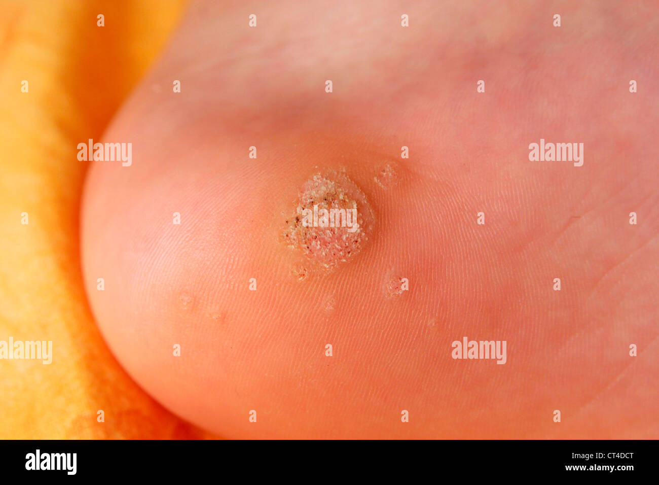 Plantar wart hi-res stock photography and images - Alamy