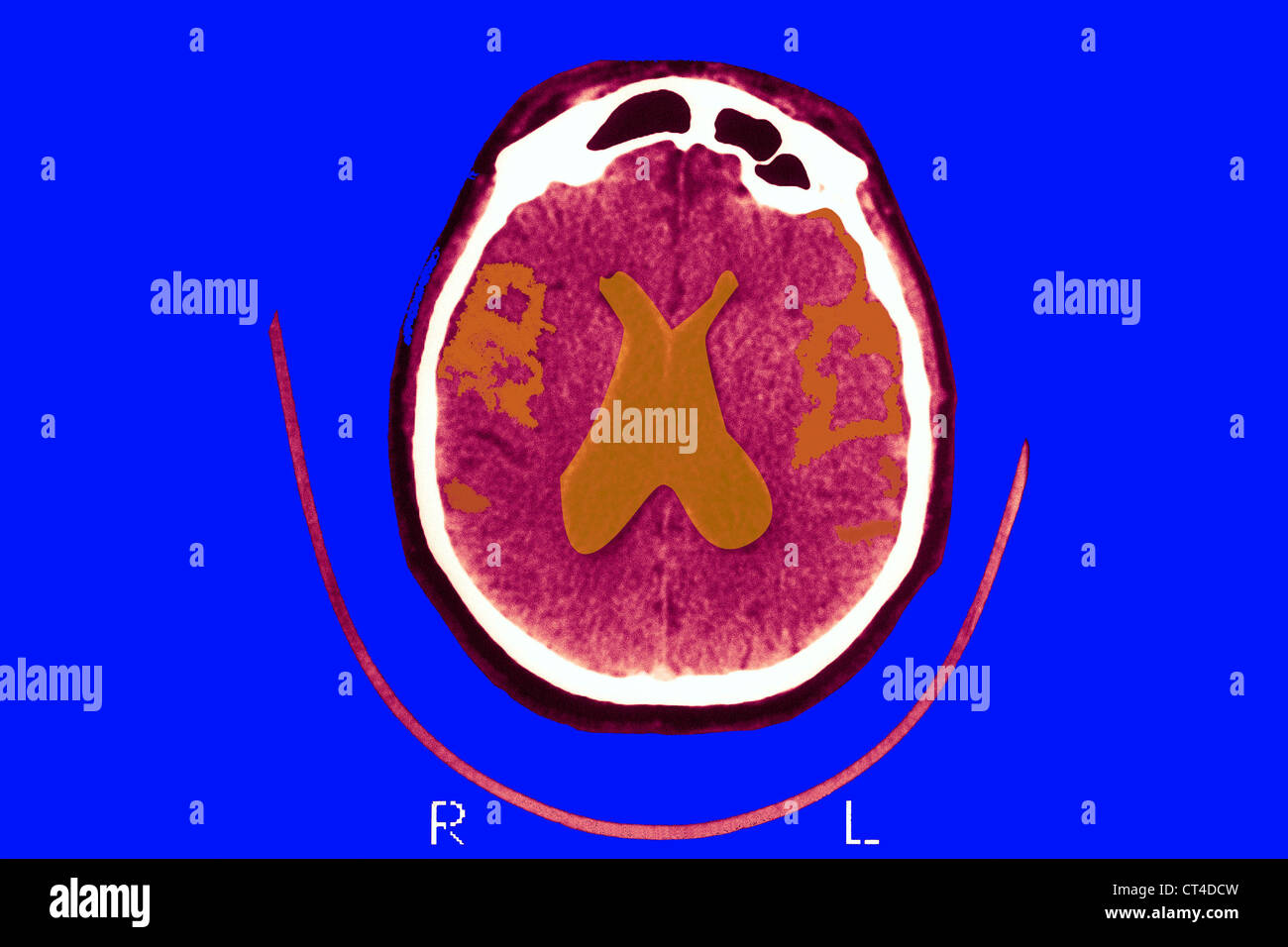 ALZHEIMER'S DISEASE, SCAN Stock Photo - Alamy