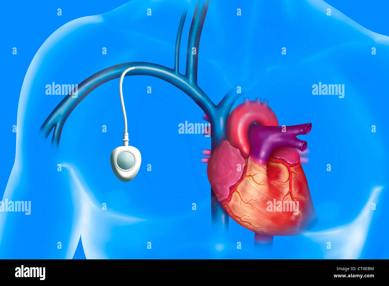 Venous access port hi-res stock photography and images - Alamy