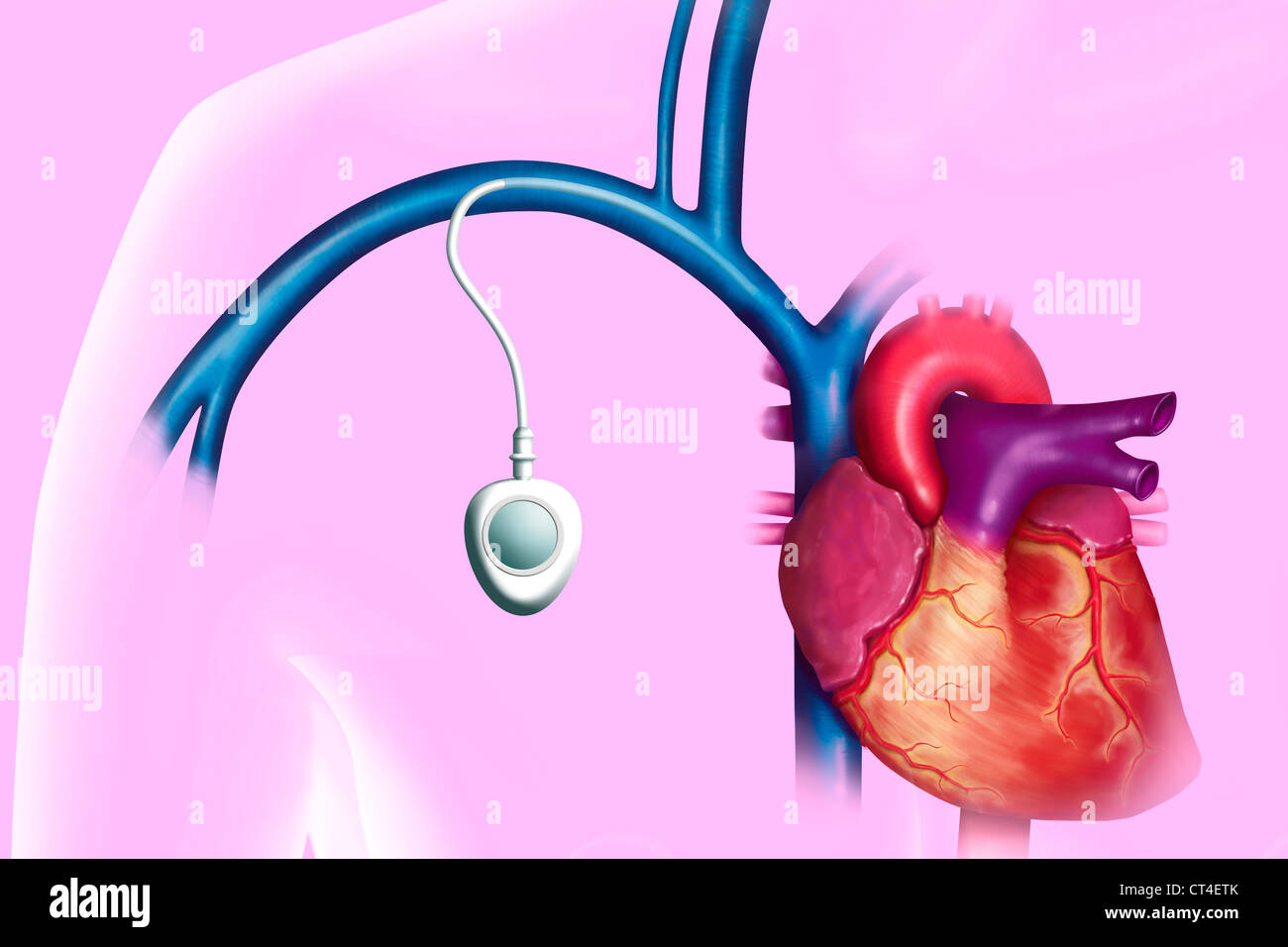 Central venous catheter hi-res stock photography and images - Alamy