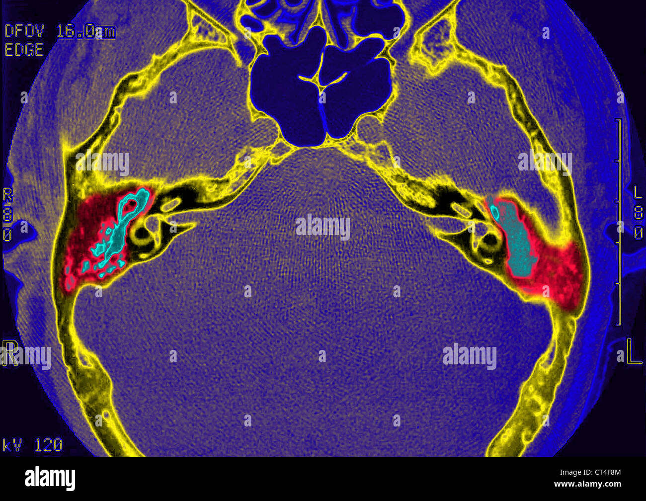 Chronic otitis hi-res stock photography and images - Alamy