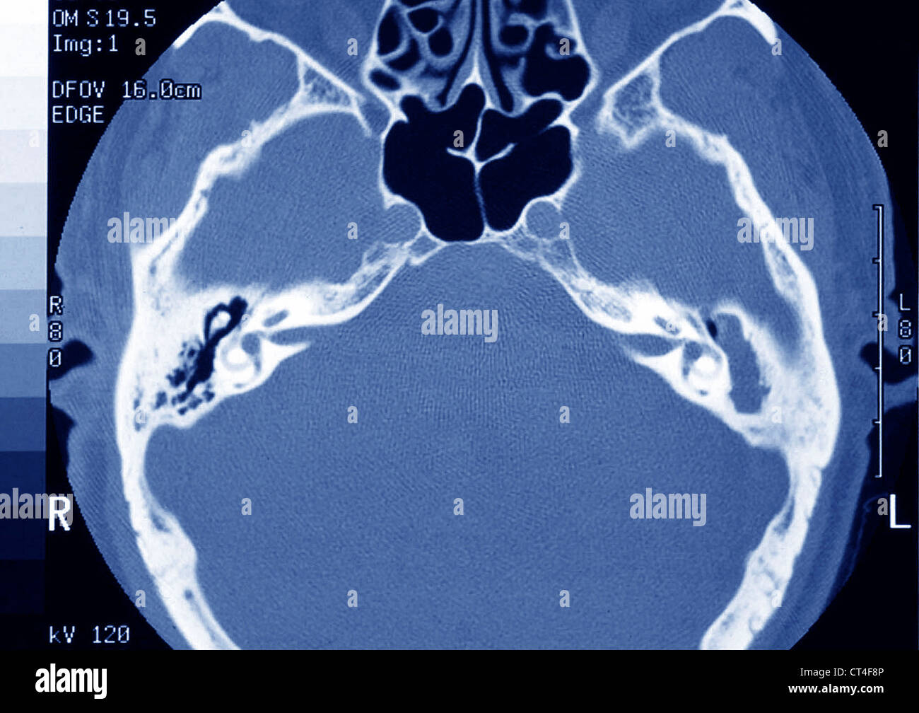 Chronic Otitis High Resolution Stock Photography and Images - Alamy