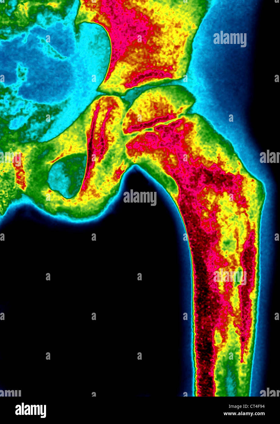 Osteomyelitis hi-res stock photography and images - Alamy