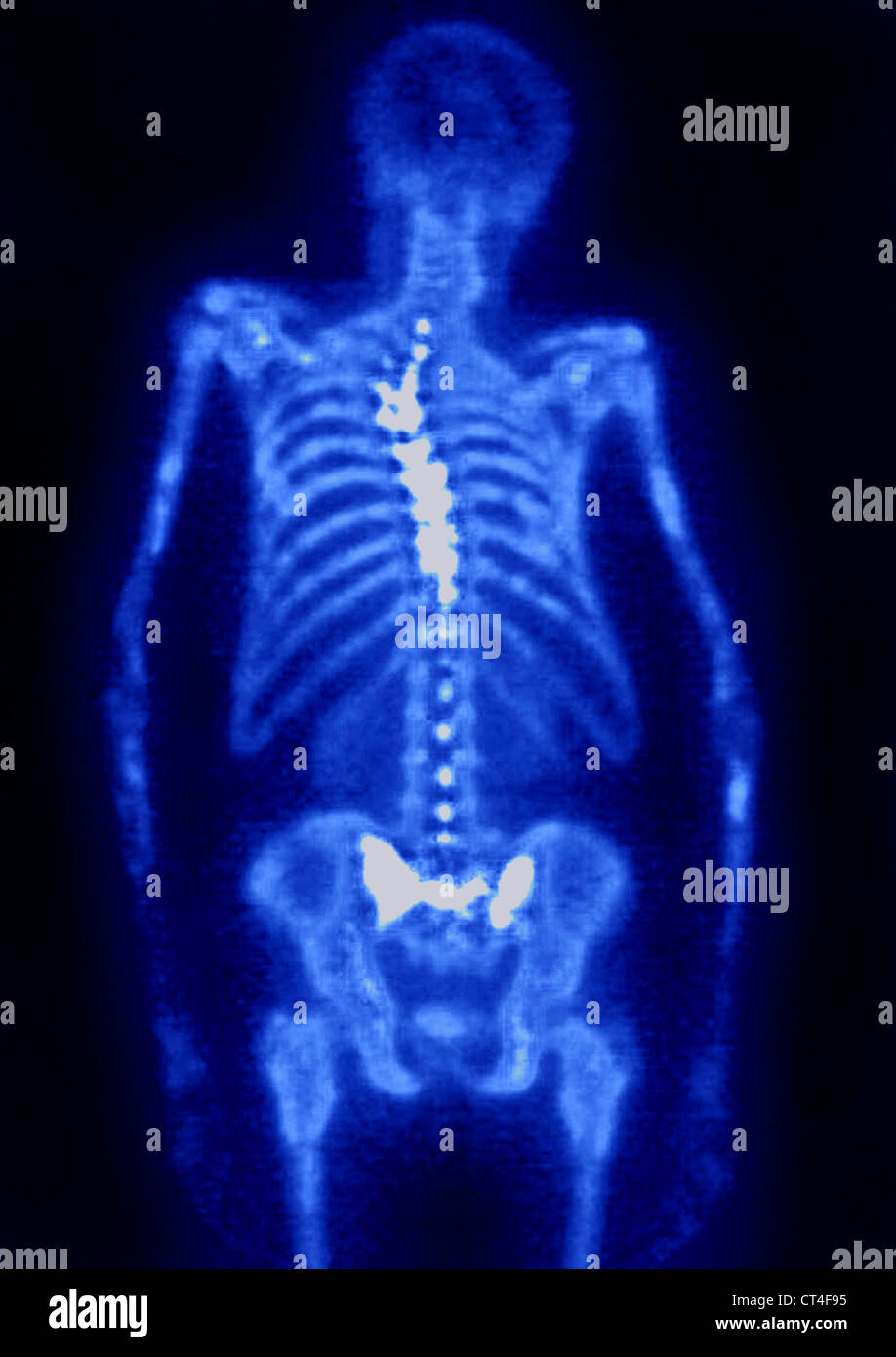 Bone scintigram of the spine hi-res stock photography and images - Alamy