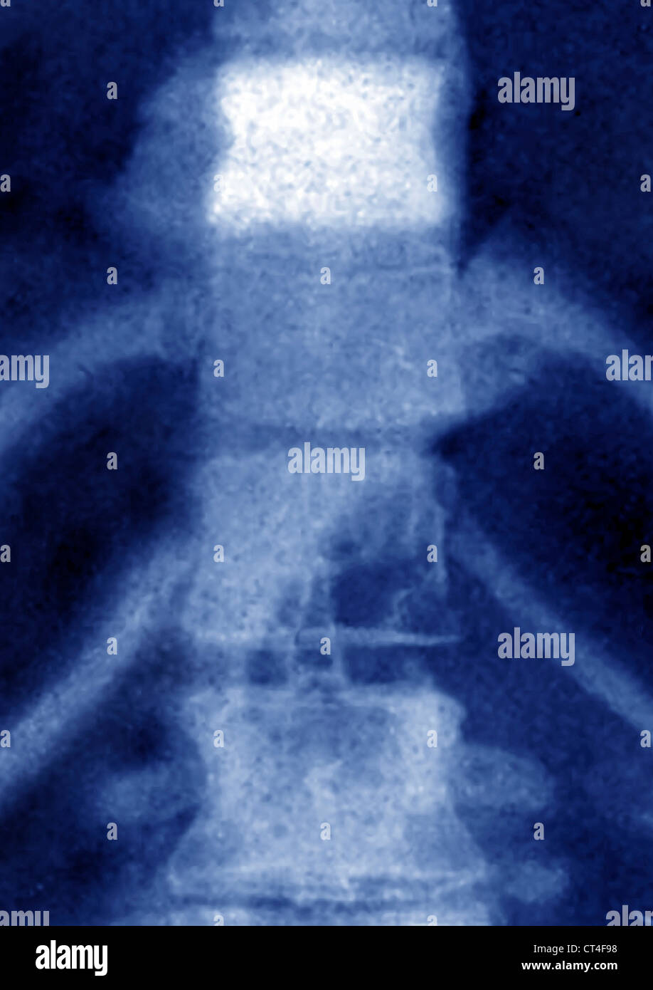 METASTASIS, THORACIC VERTEBRAE Stock Photo - Alamy
