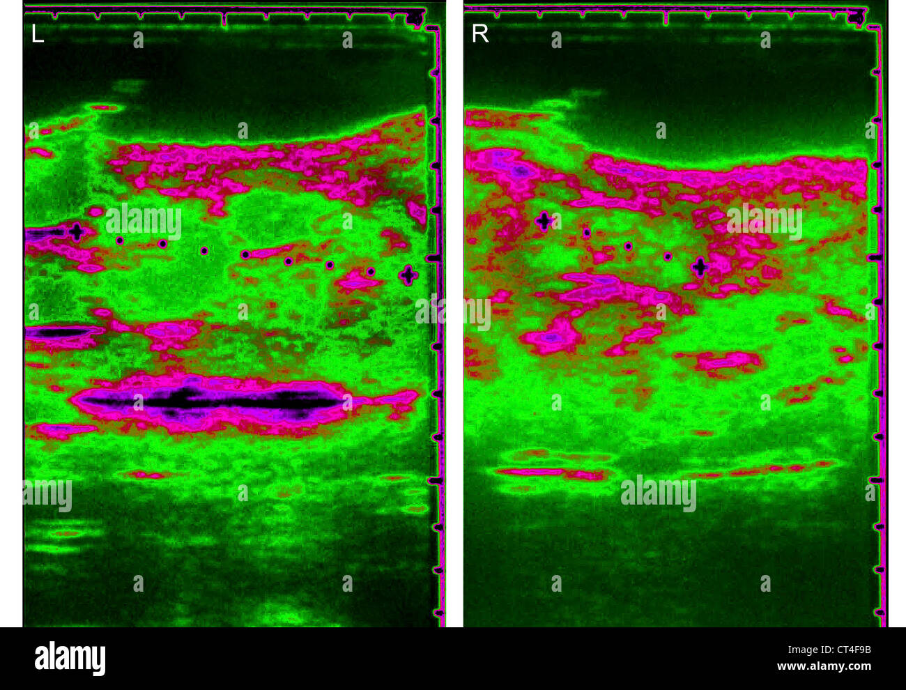 MULTICYSTIC DYSPLASTIC KIDNEY Stock Photo - Alamy