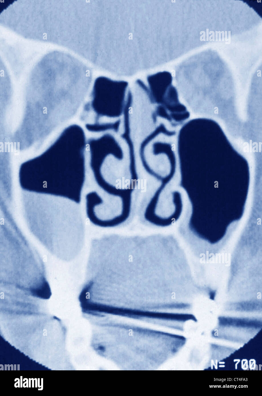 Sinus mri hi-res stock photography and images - Alamy