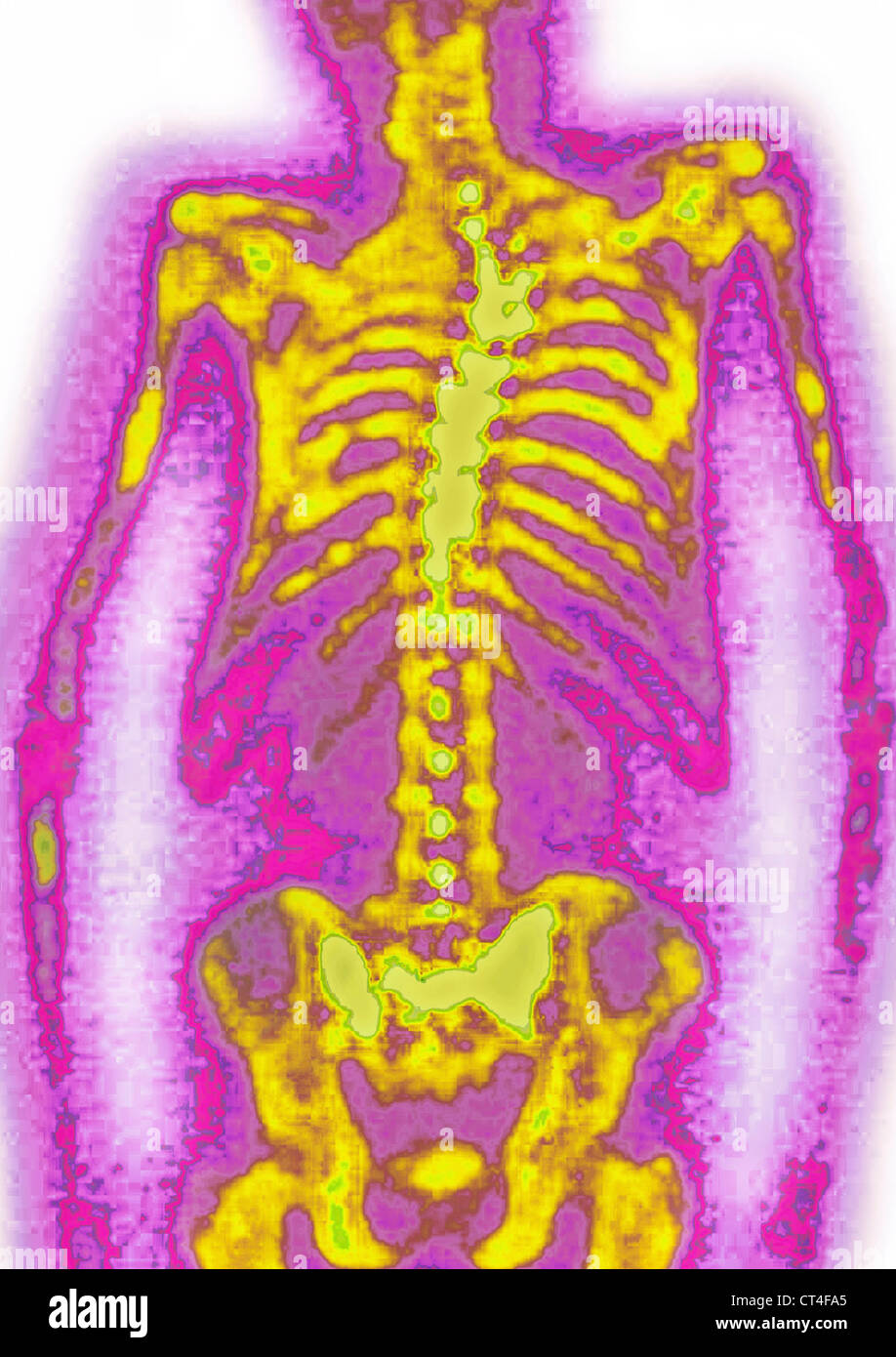 Bone scintigram of the spine hi-res stock photography and images - Alamy