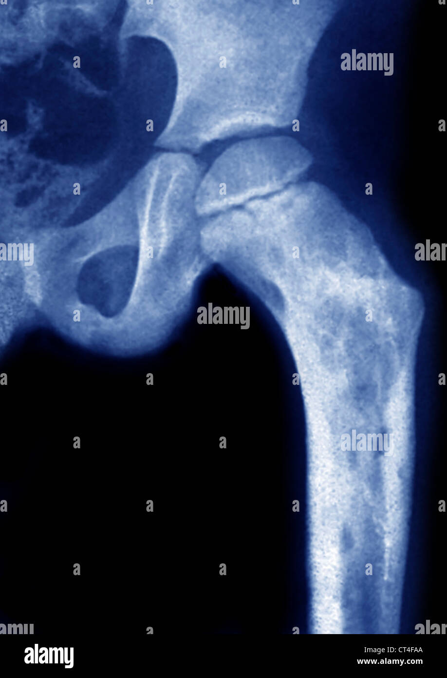 Osteomyelitis hi-res stock photography and images - Alamy