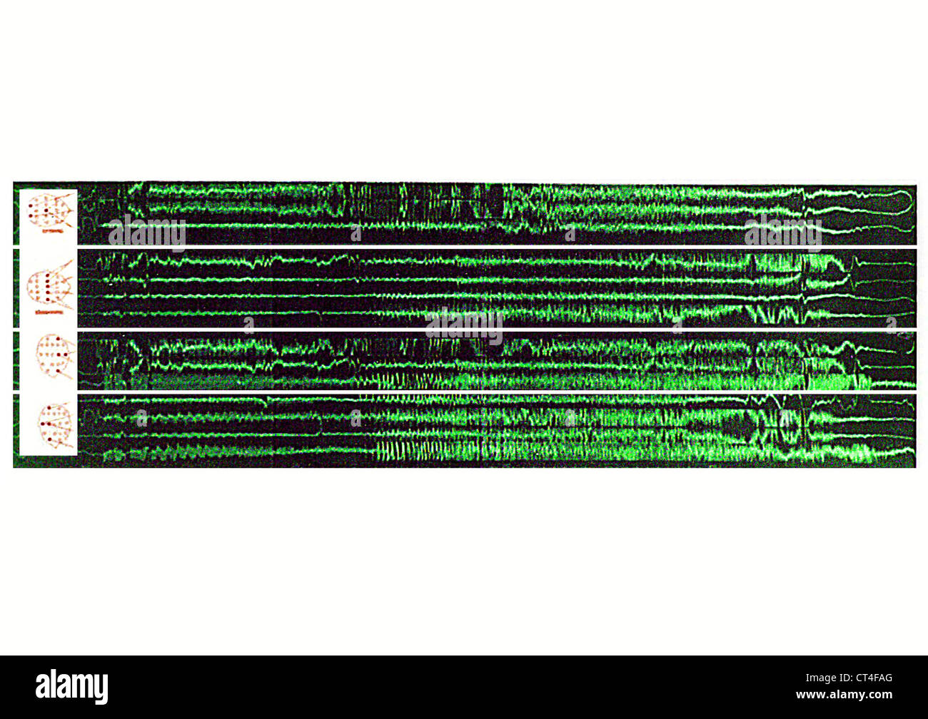 Eeg trace hi-res stock photography and images - Alamy