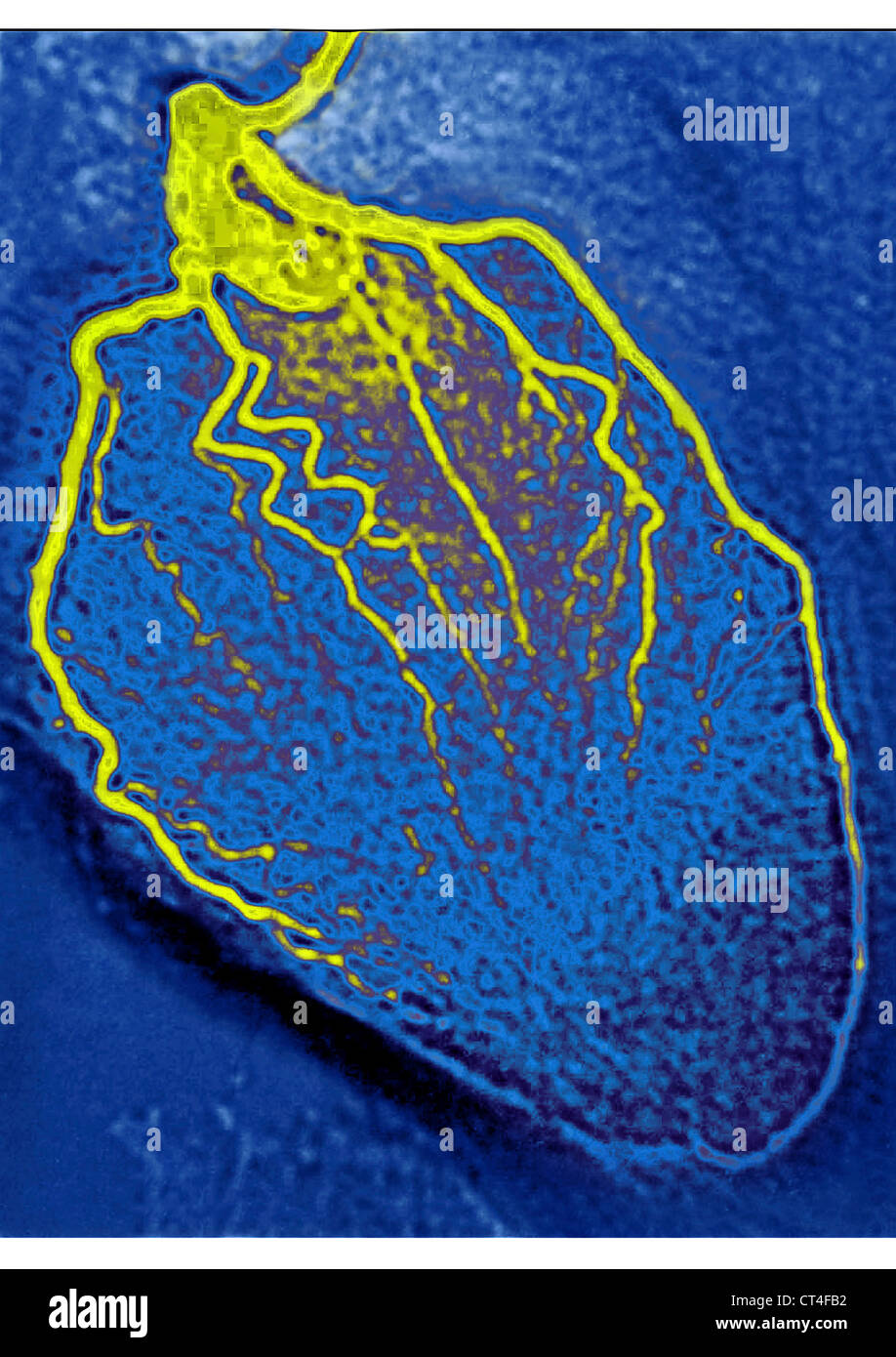Coronary angiography healthy heart hi-res stock photography and images ...