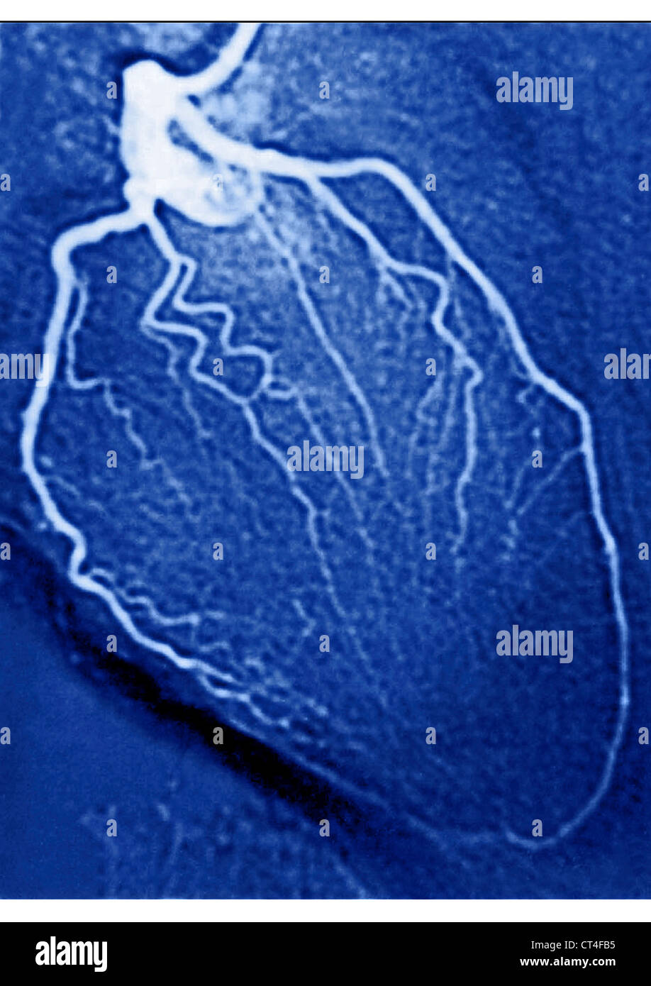Coronary angiography healthy heart hi-res stock photography and images ...