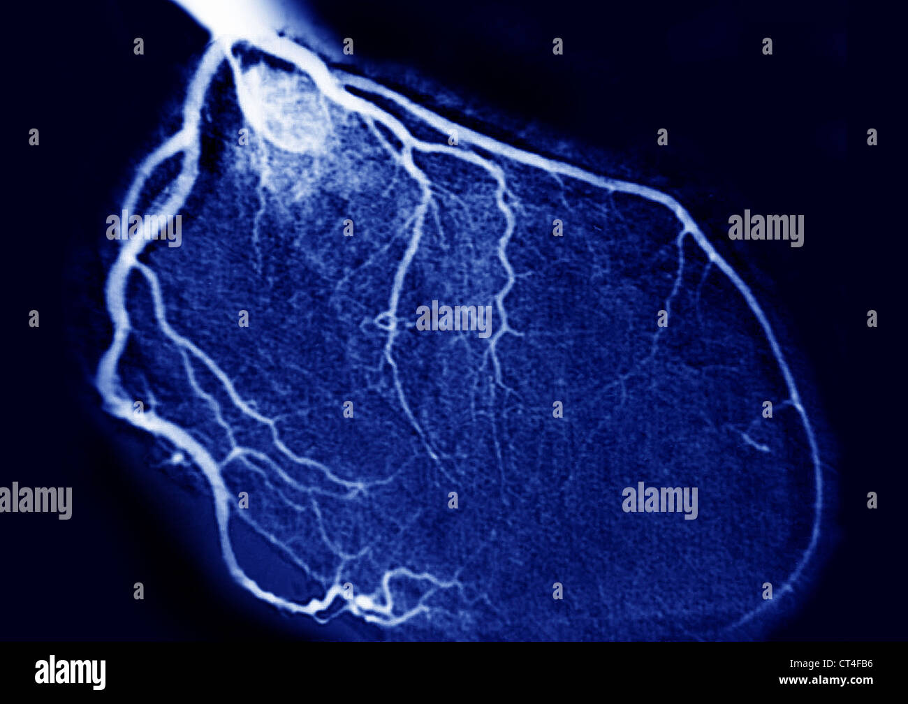 Coronary angiography healthy heart hi-res stock photography and images ...