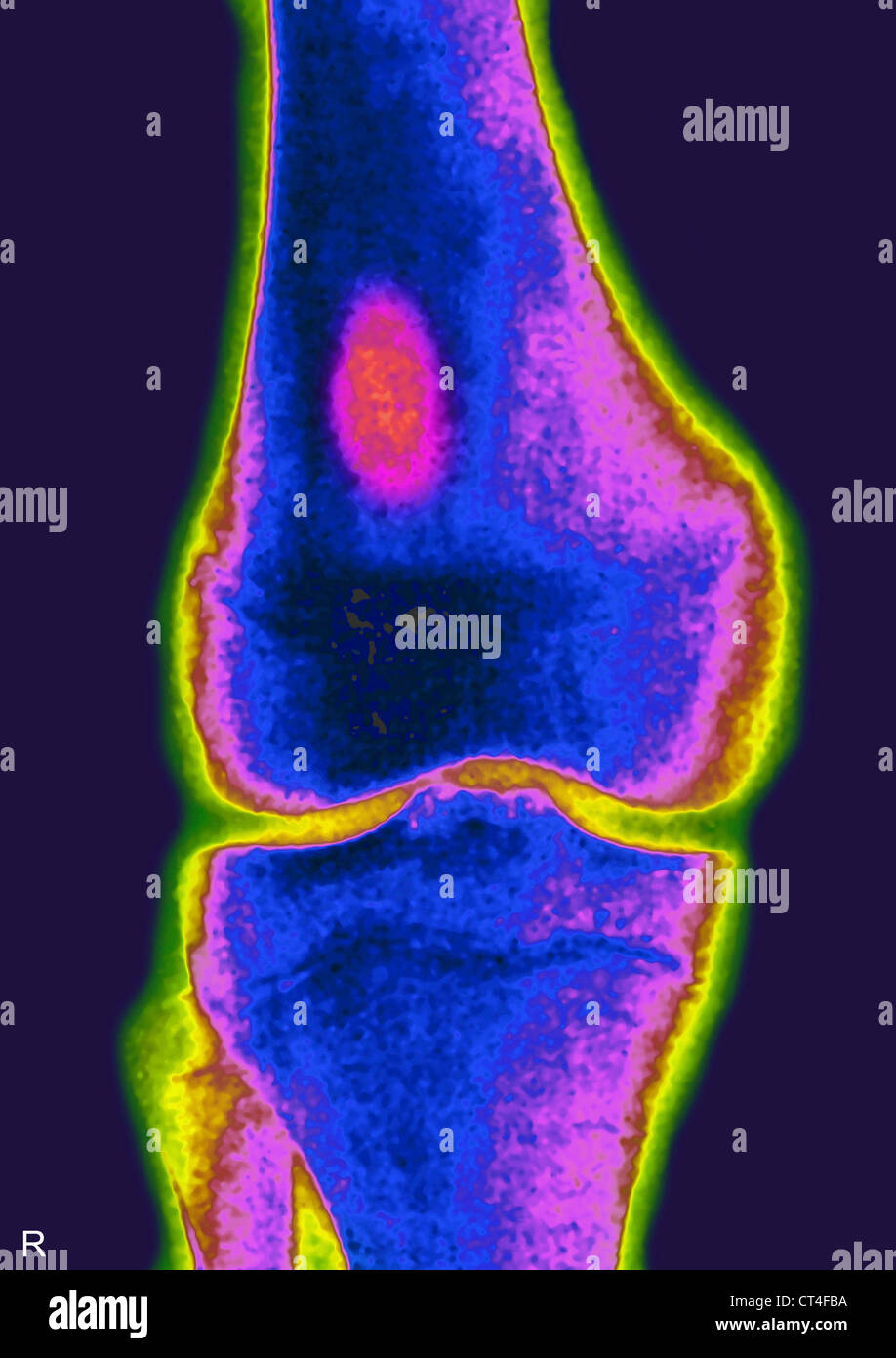 Staphylococcal High Resolution Stock Photography and Images - Alamy