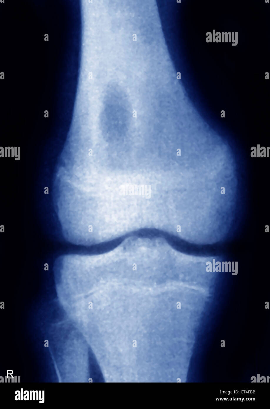 Staphylococcal hi-res stock photography and images - Alamy