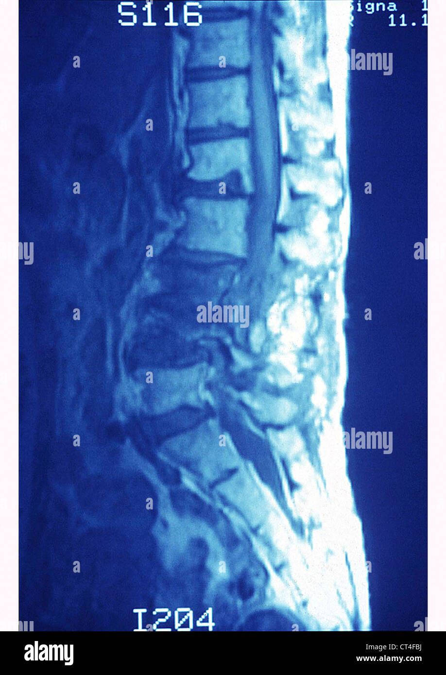 COMPRESSION FRACTURE, MRI Stock Photo - Alamy