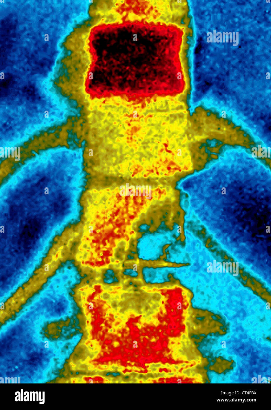 METASTASIS, THORACIC VERTEBRAE Stock Photo - Alamy