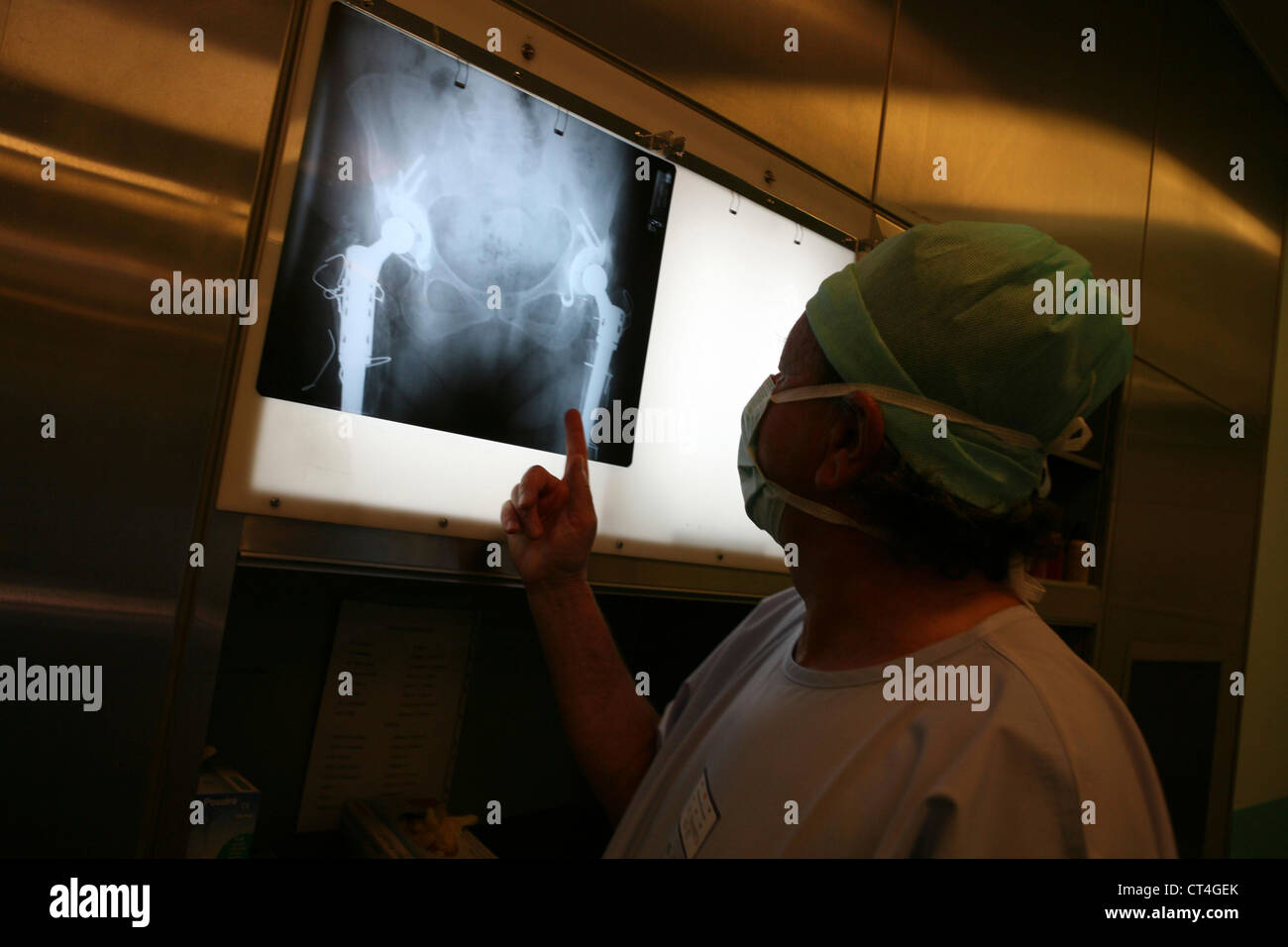 HIP PROSTHESIS, X-RAY Stock Photo - Alamy